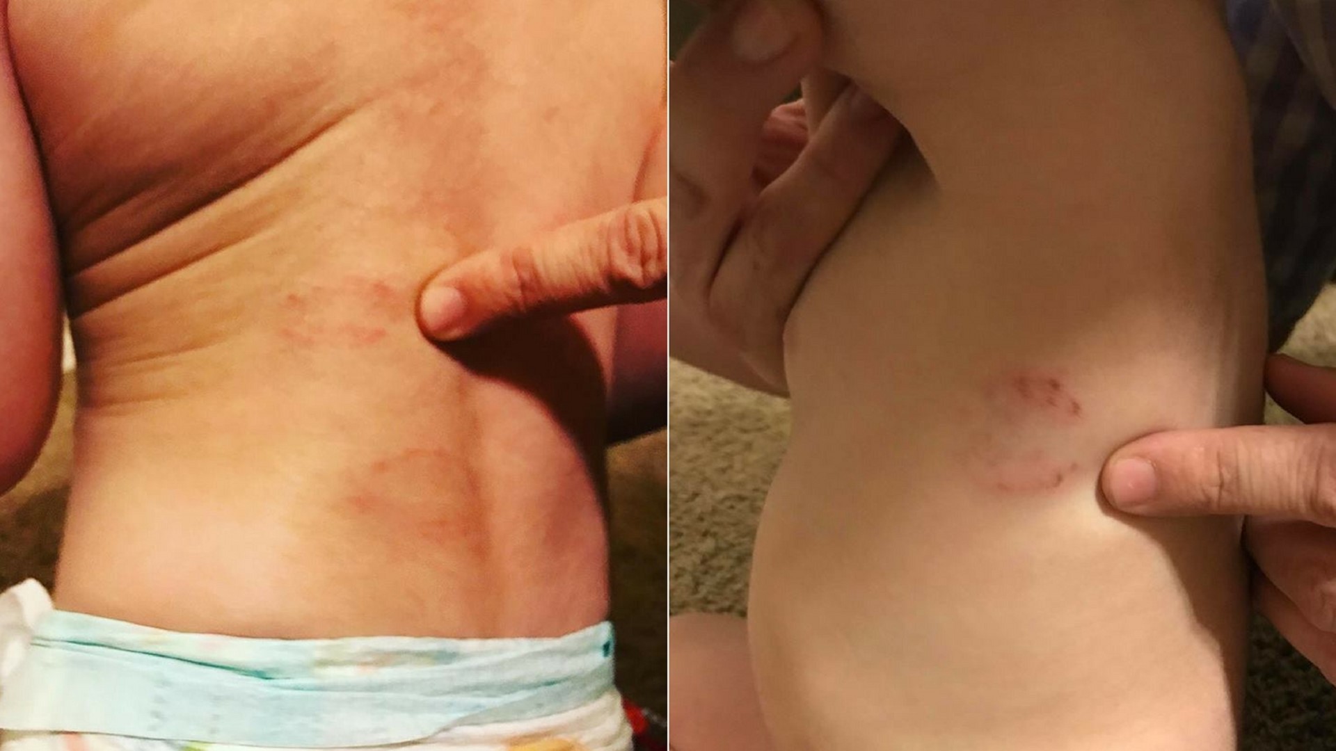 2-year-old comes home from preschool covered in bite marks | abc10.com