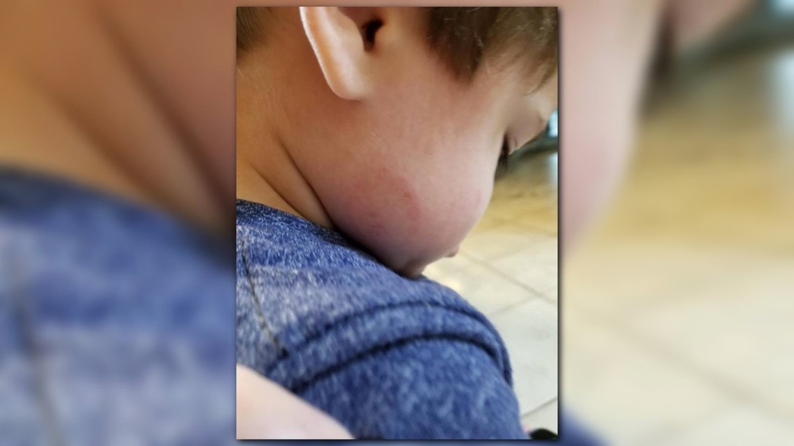 2-year-old comes home from preschool covered in bite marks | abc10.com