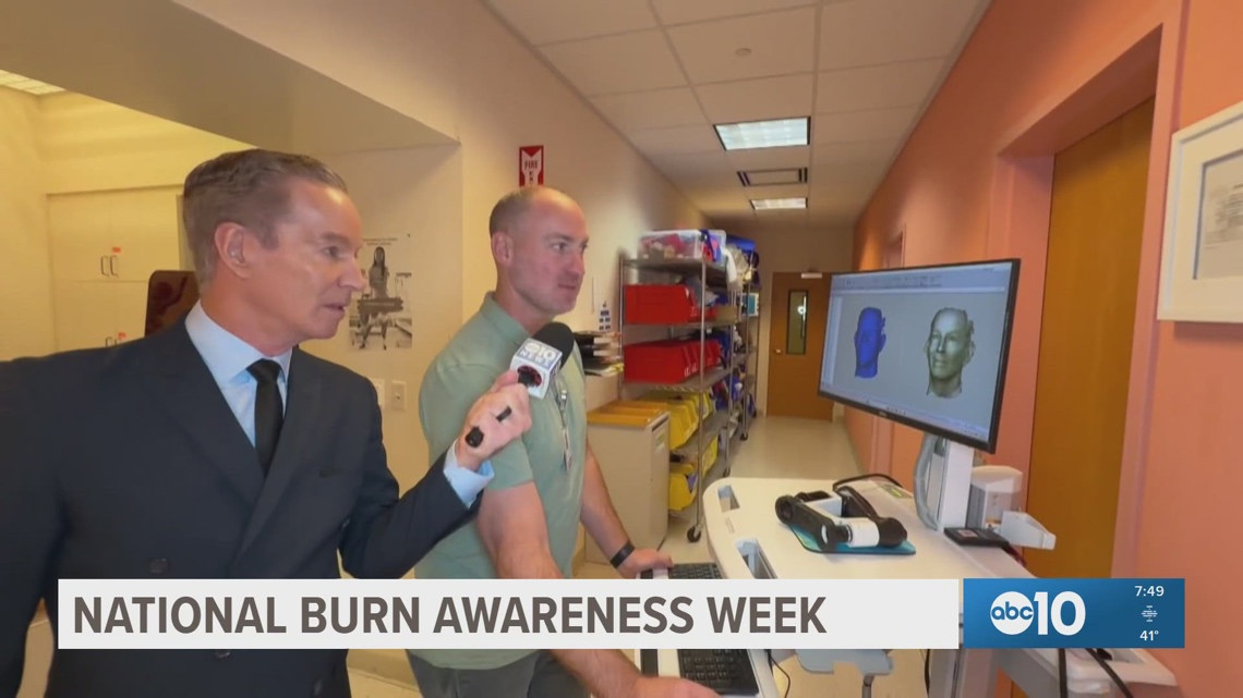 How are 3D masks that help burn victims made? | abc10.com