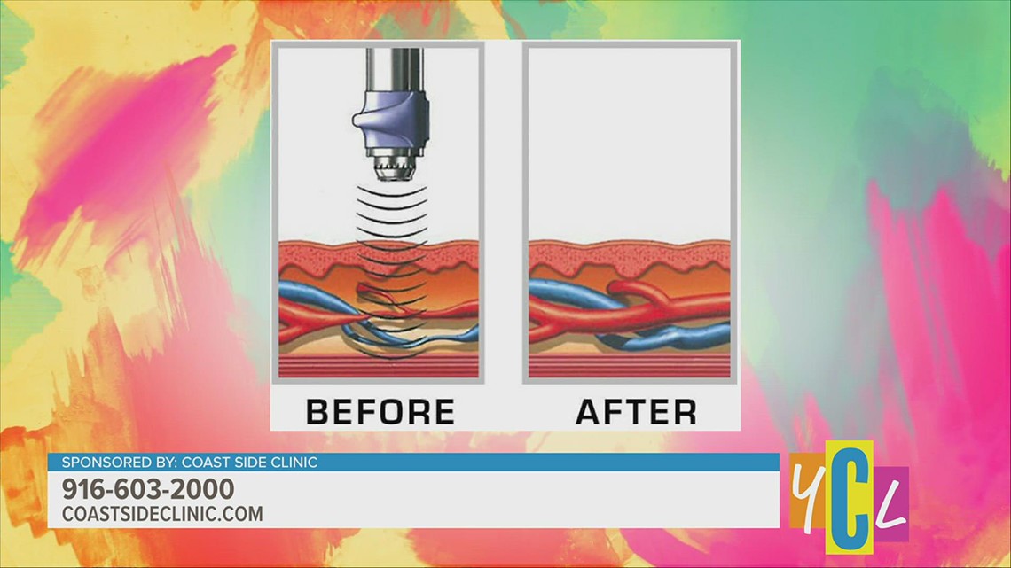 The True Pulse Protocol Treatment Explained | abc10.com