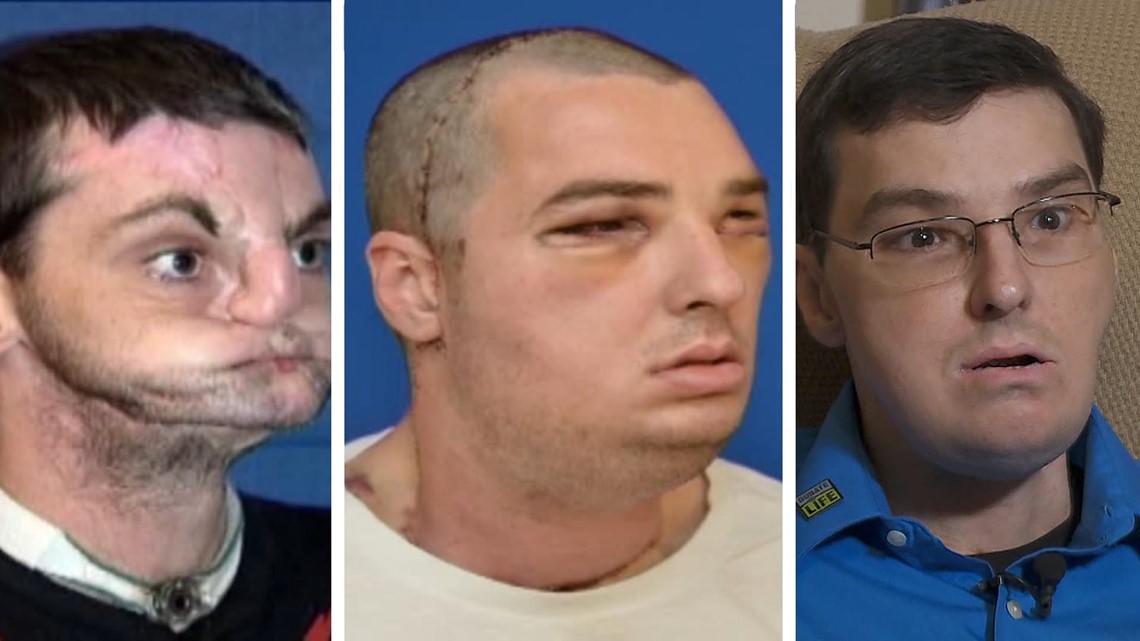 After surviving first-ever face transplant, Covington man needs another ...